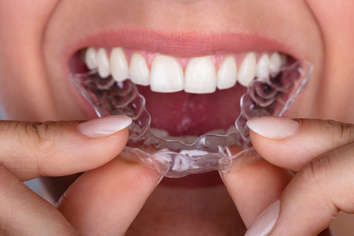 Does Invisalign Really Work?- Bella Dental of Holmdel